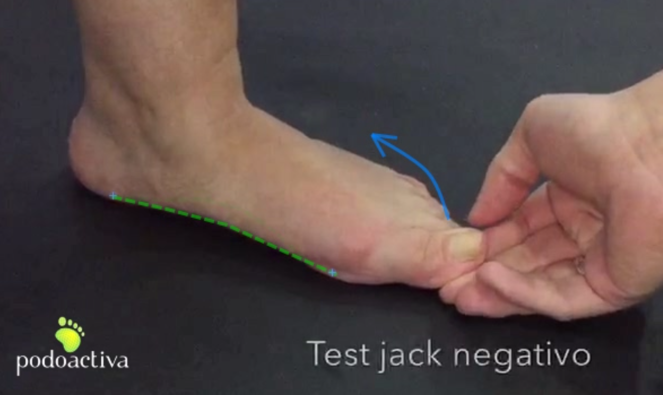 Test de Jack - Podoactiva. Líderes en Podología