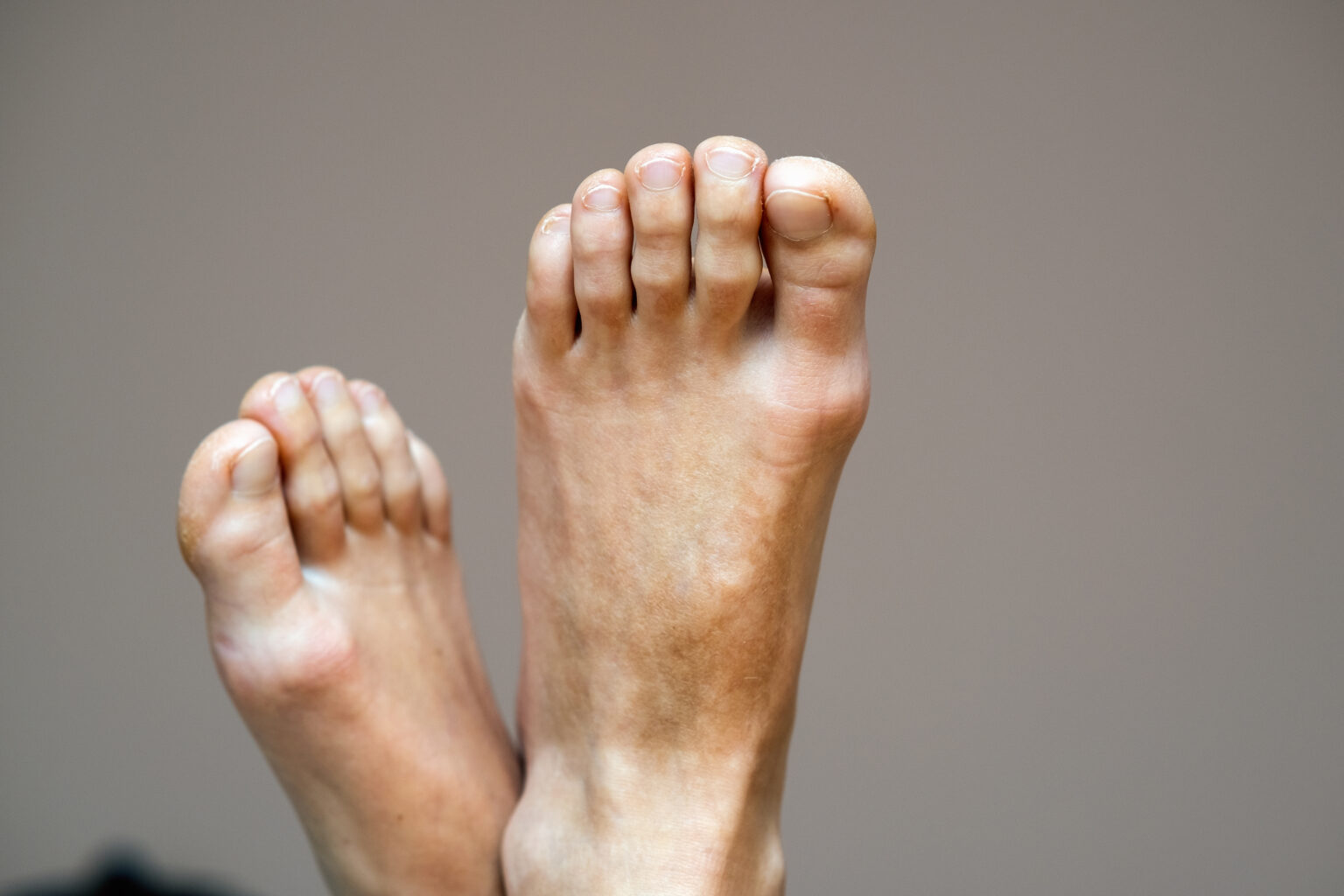 Hallux Limitus y Hallux Rigidus. Lo que tienes que saber - Podoactiva ...