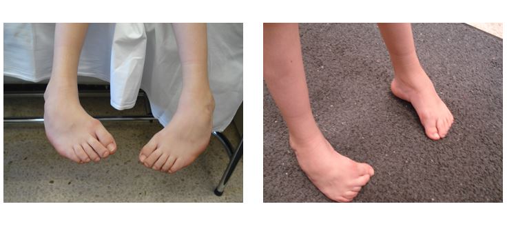 Pie zambo o equinovaro. Qué es y cómo tratarlo