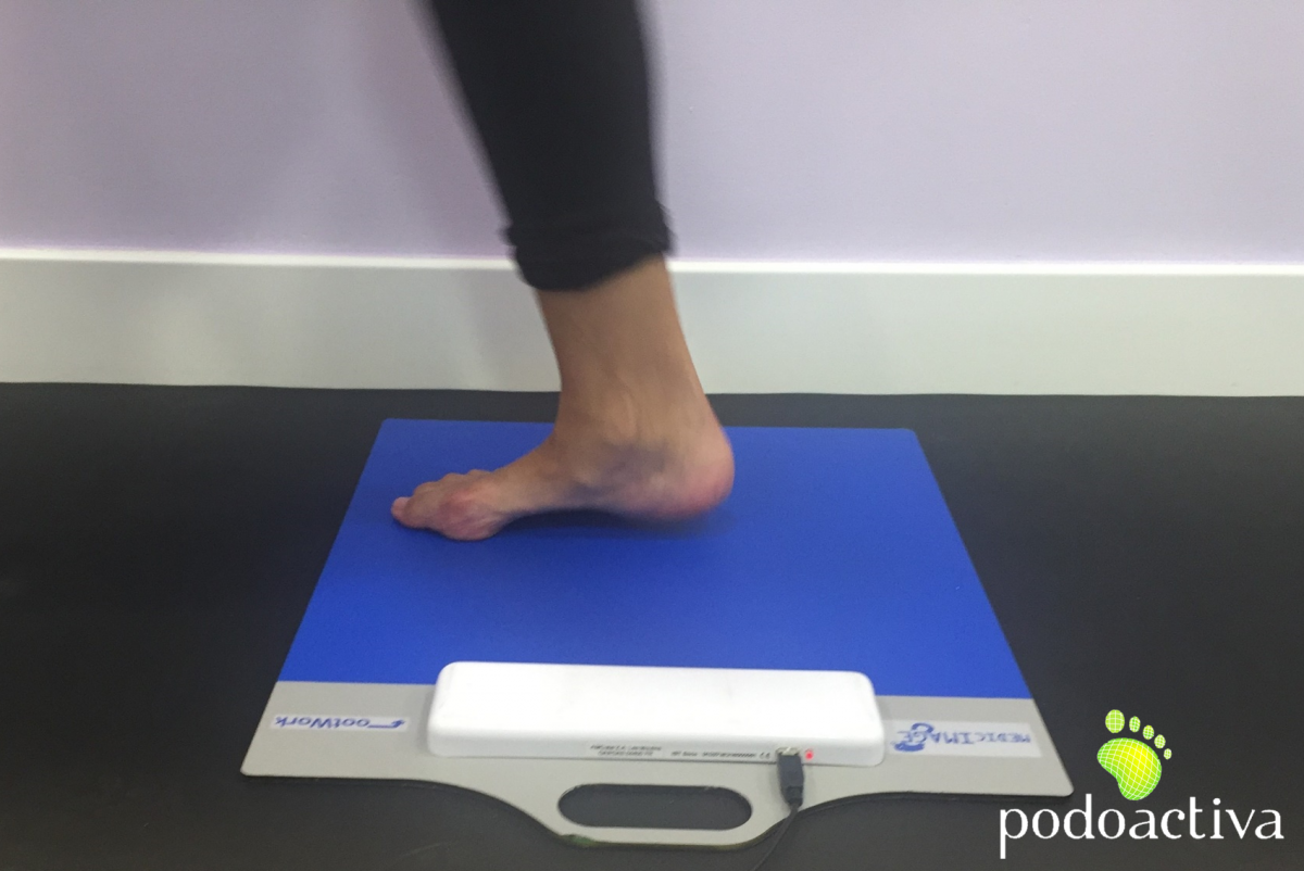 Hallux Rigidus: Qué es y cómo se trata