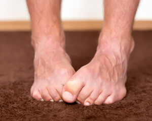 Pie de atleta. Tipos de infección y consejos para prevenirlo