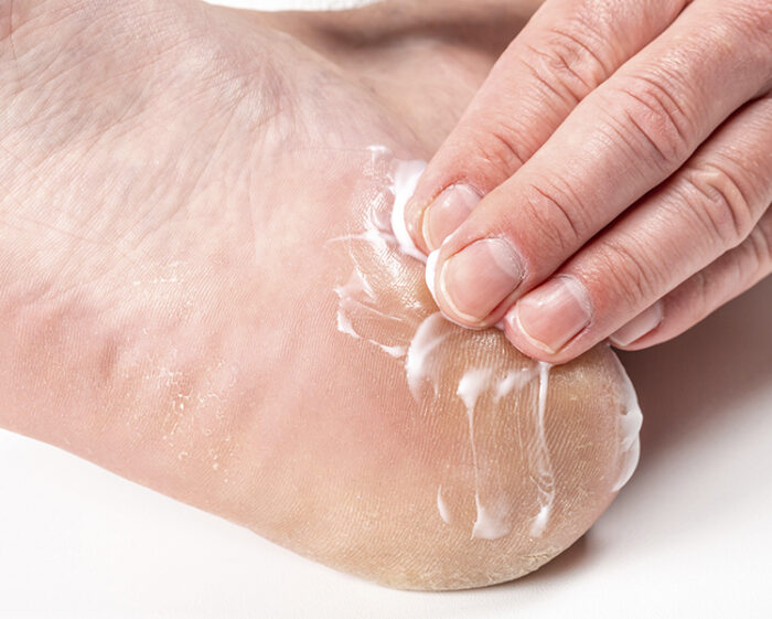 Pie de atleta. Tipos de infección y consejos para prevenirlo