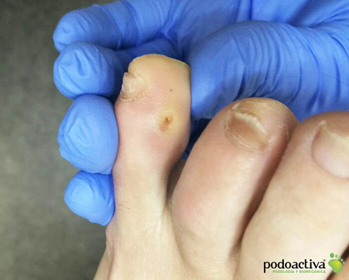 Callos en los pies o callosidades. Cómo tratarlos y cómo prevenirlos