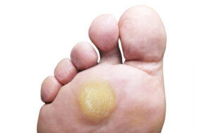 Callos en los pies o callosidades. Cómo tratarlos y cómo prevenirlos