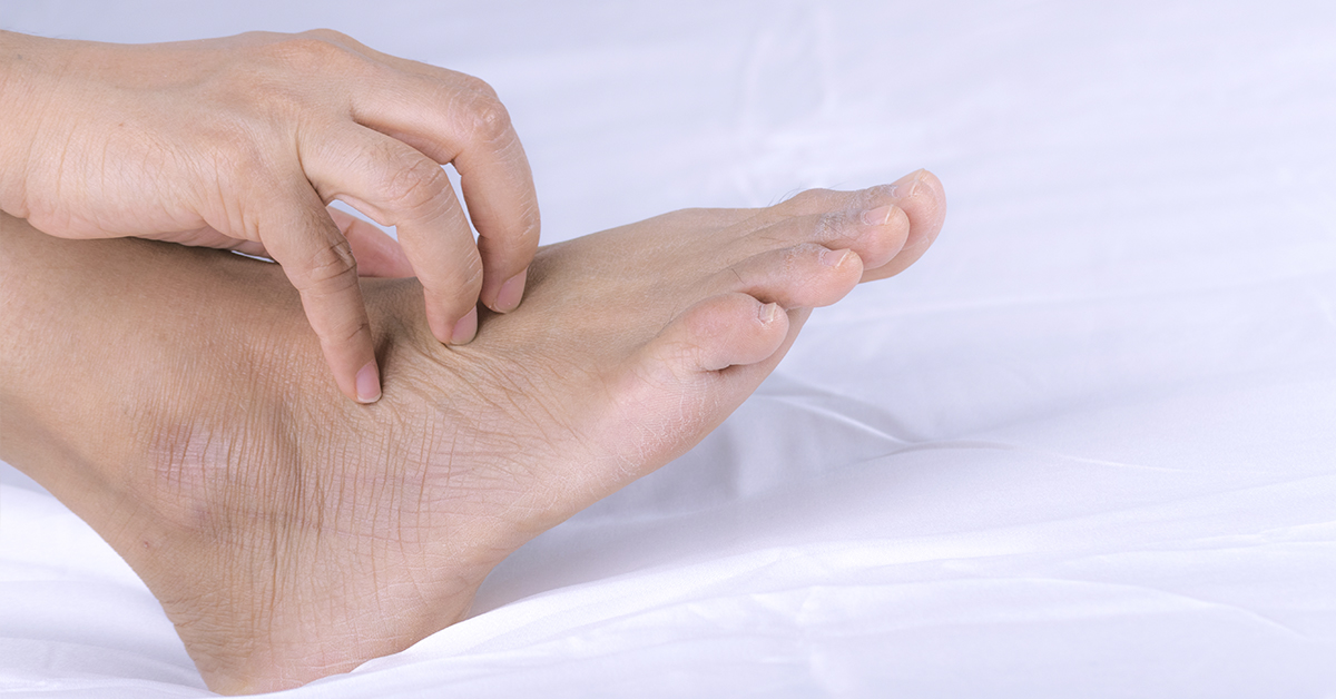 Psoriasis en las uñas, piel y articulaciones de los pies. Consejos para ...