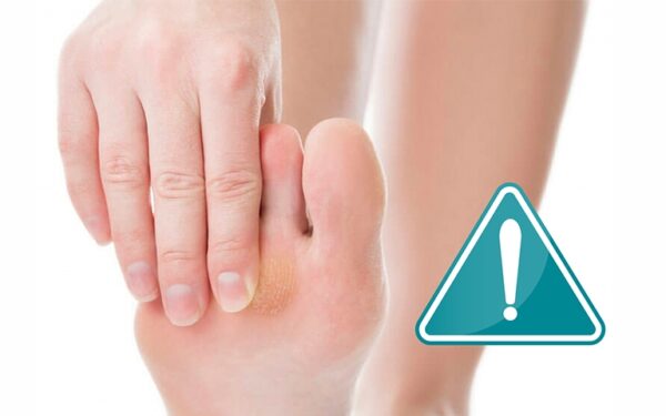 Callos en los pies o callosidades. Cómo tratarlos y cómo prevenirlos