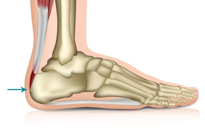Talalgia: Qué es, causas y tratamiento