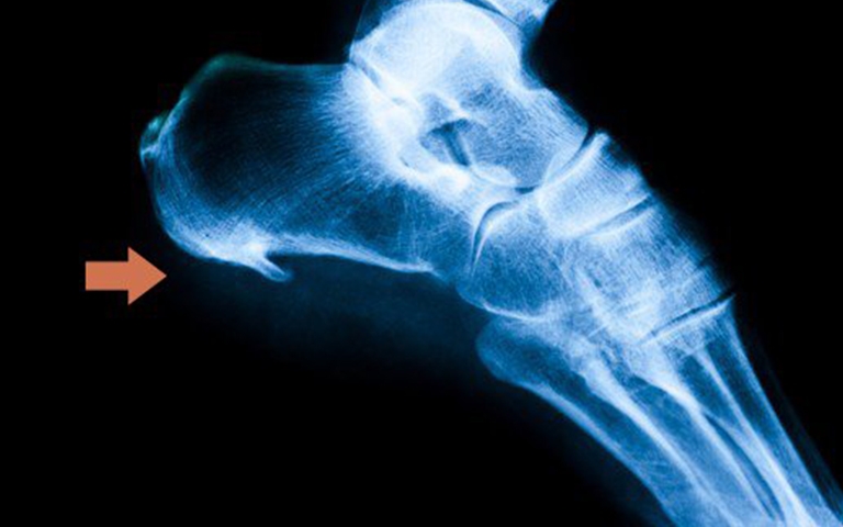 Talalgia: Qué es, causas y tratamiento