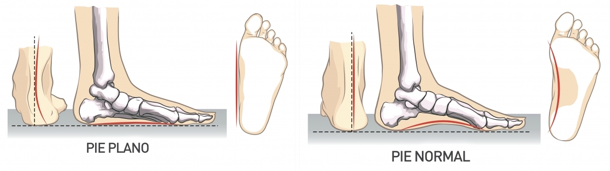 Huella plantar. Tipos, cómo se analiza y qué dice sobre tus pies