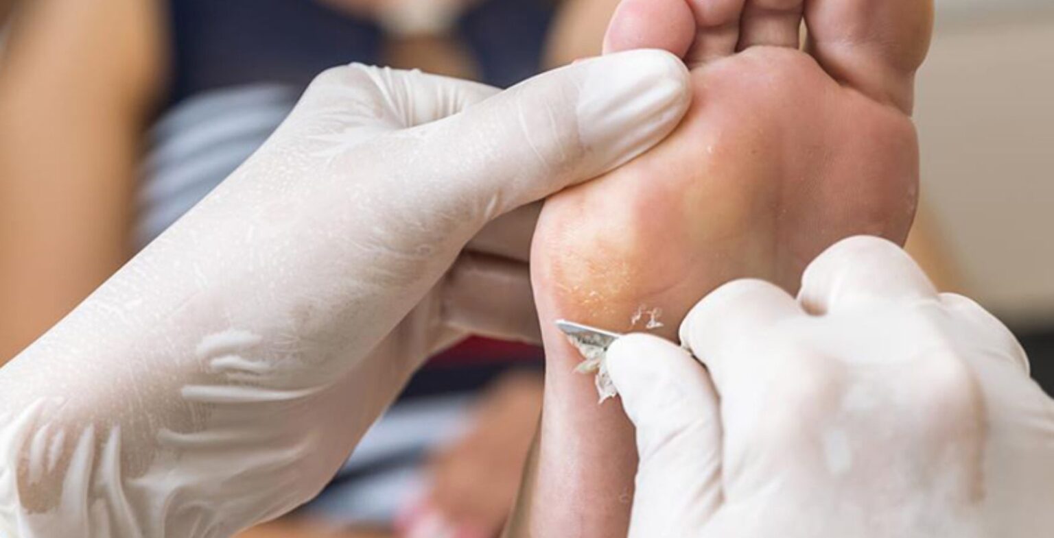 Callos en los pies o callosidades. Cómo tratarlos y cómo prevenirlos