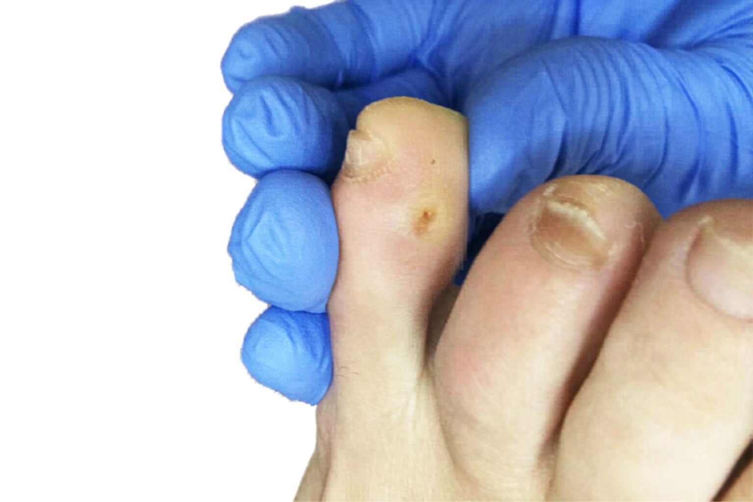 Callos en los pies o callosidades. Cómo tratarlos y cómo prevenirlos
