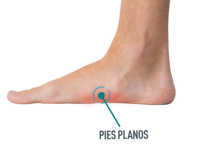Operación para corregir el pie plano - Podoactiva. Líderes en Podología