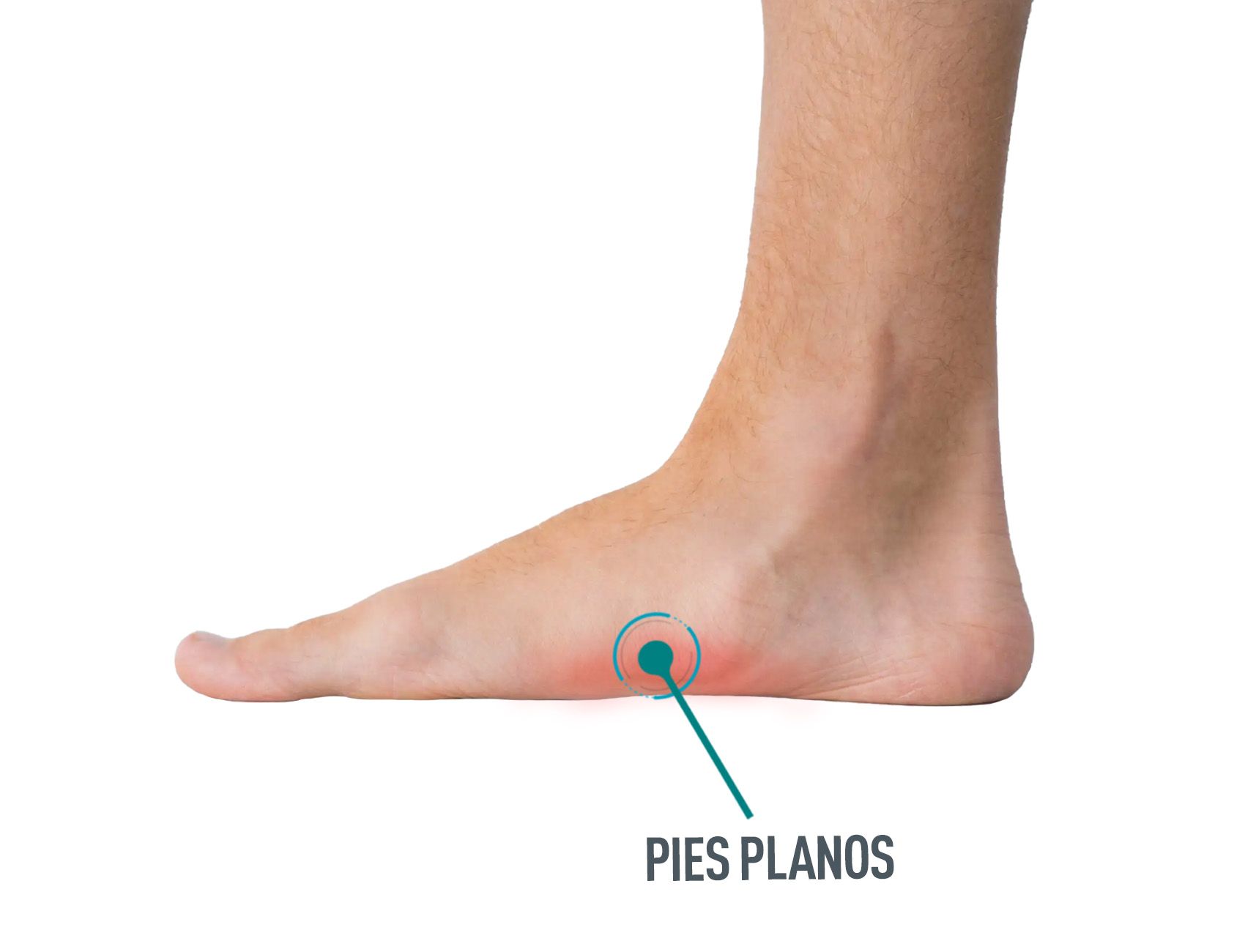 Pies planos valgos: Qué son, tratamiento y ejercicios