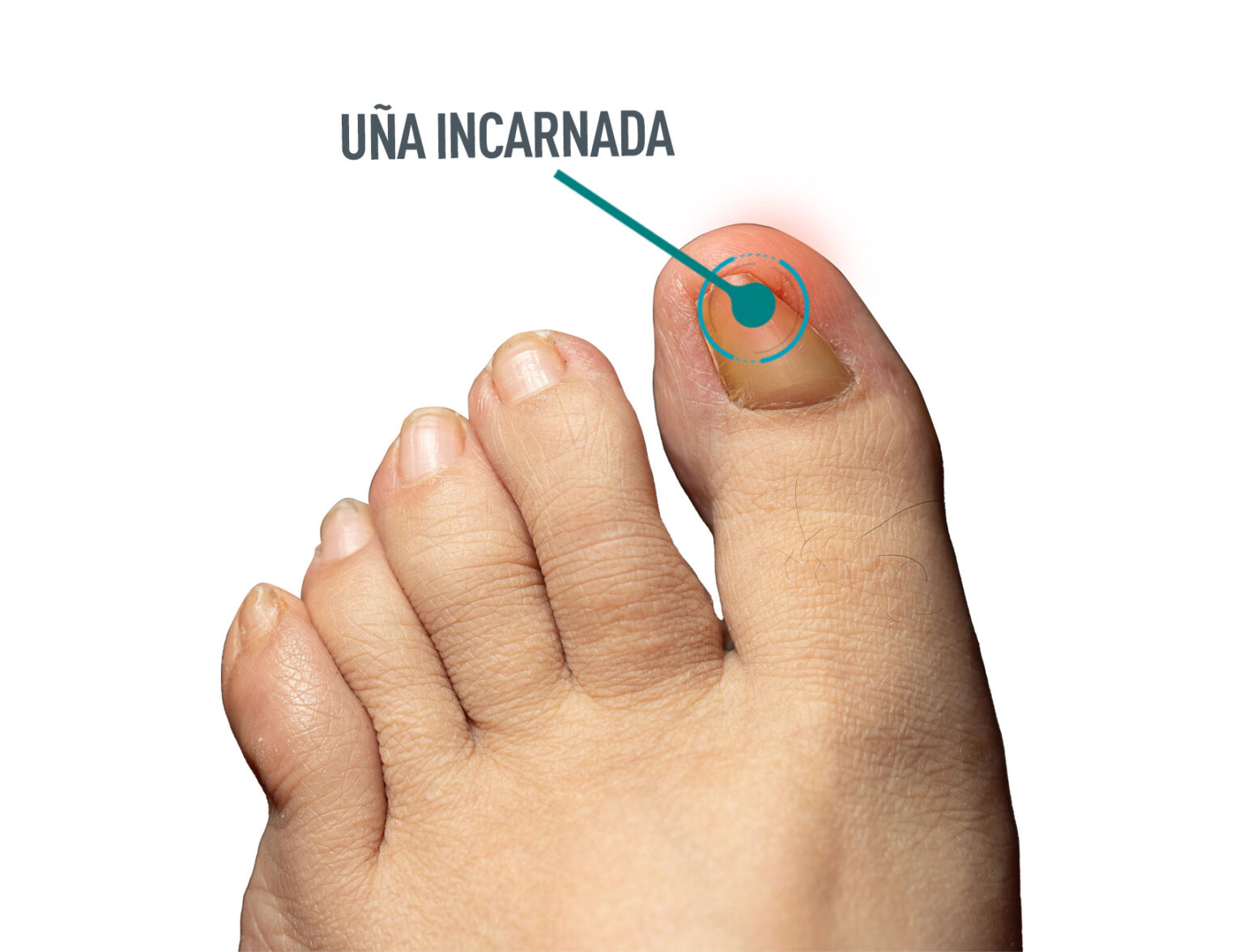 Hallux varus o pie en sandalia. Qué es, síntomas y tratamiento ...