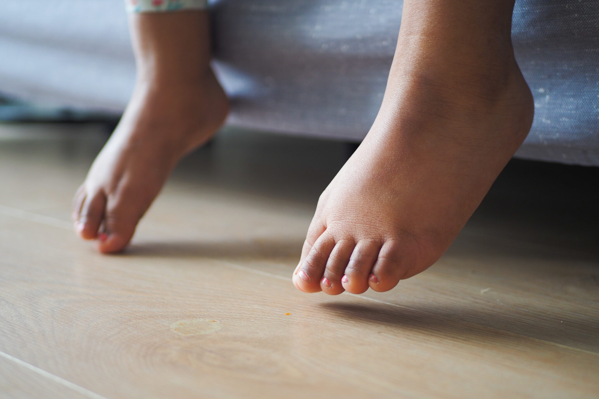 Pie valgo: Qué es y tratamiento - Podoactiva. Podología y biomecánica