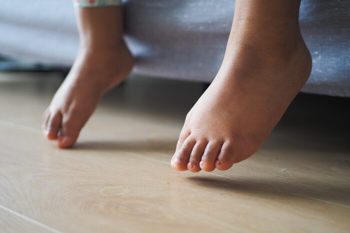 Pie valgo: Qué es y tratamiento - Podoactiva. Podología y biomecánica