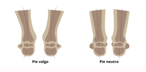 Pie valgo: Qué es y tratamiento - Podoactiva. Podología y biomecánica