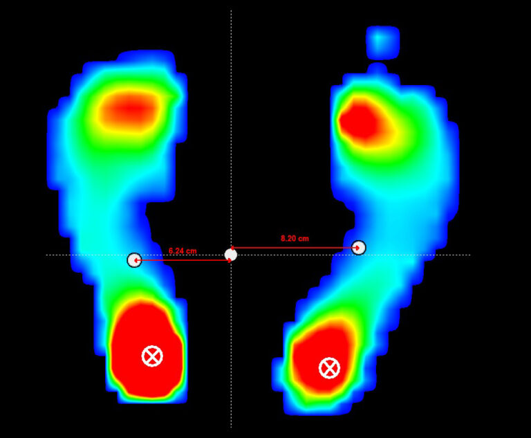Pie valgo: Qué es y tratamiento - Podoactiva. Podología y biomecánica