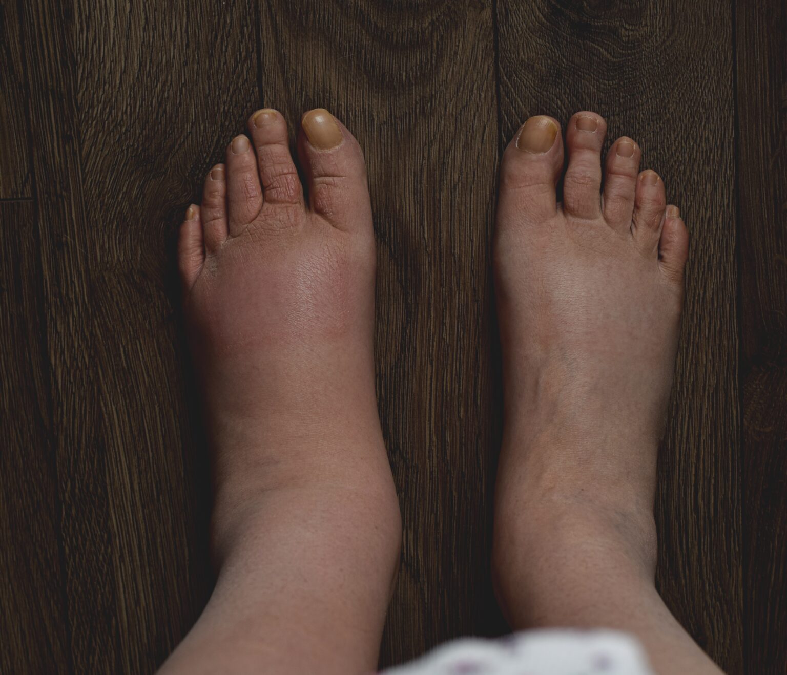 ¿Qué es el síndrome de Sudeck? - Podoactiva. Podología y biomecánica