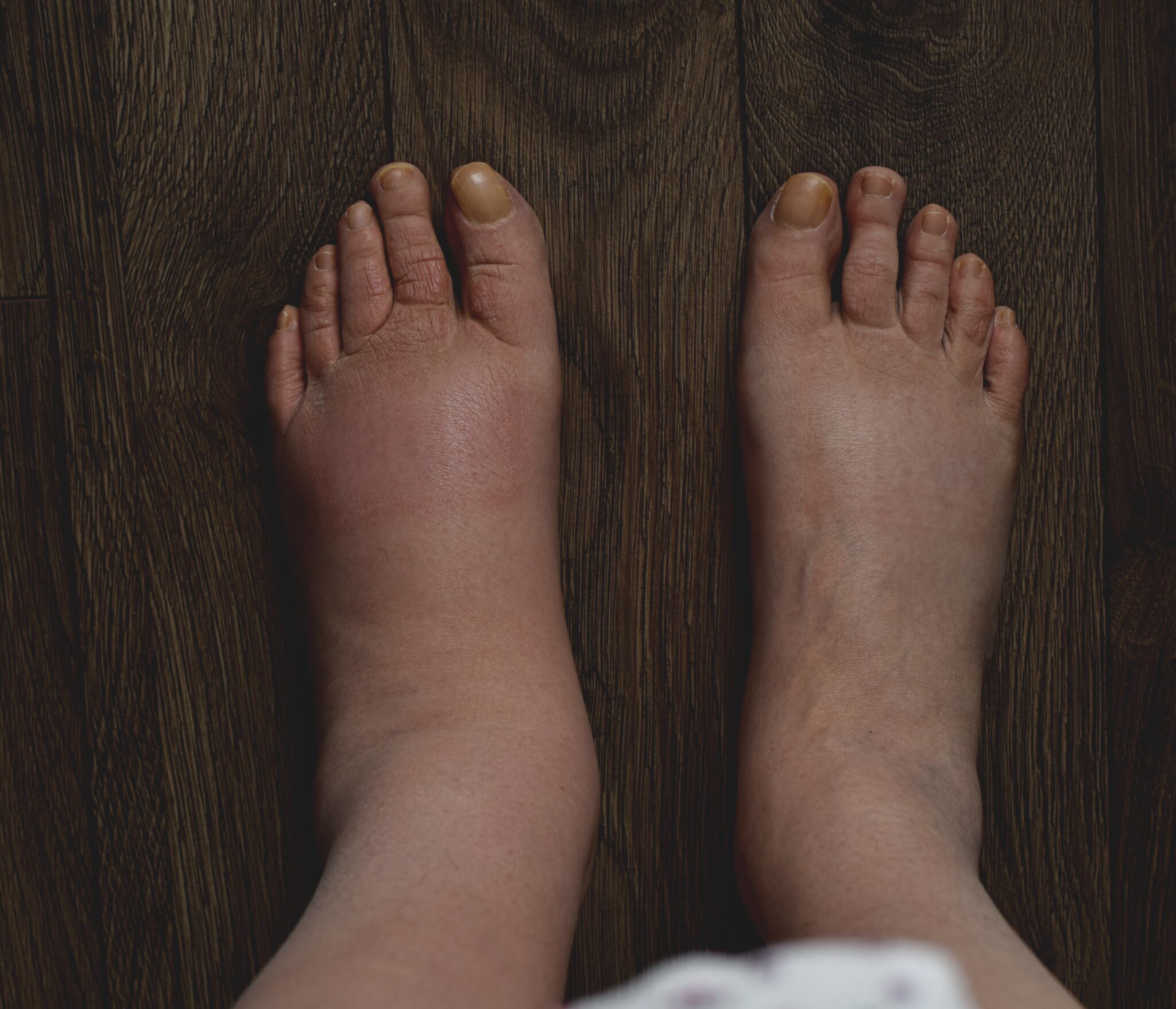 ¿Qué es el síndrome de Sudeck? - Podoactiva. Podología y biomecánica