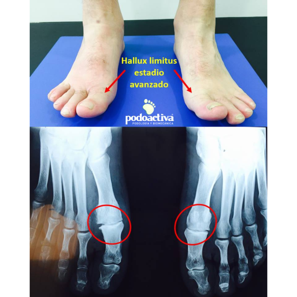 Hallux Limitus y Hallux Rigidus. Lo que tienes que saber - Podoactiva ...