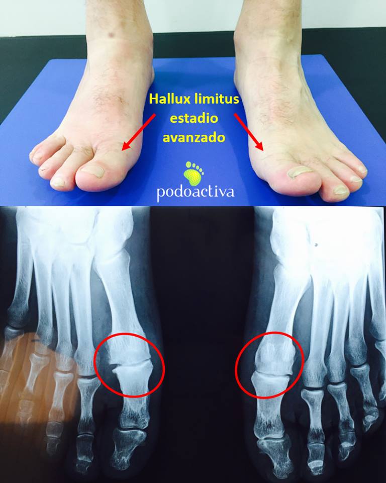 Hallux limitus - Podoactiva. Líderes en Podología