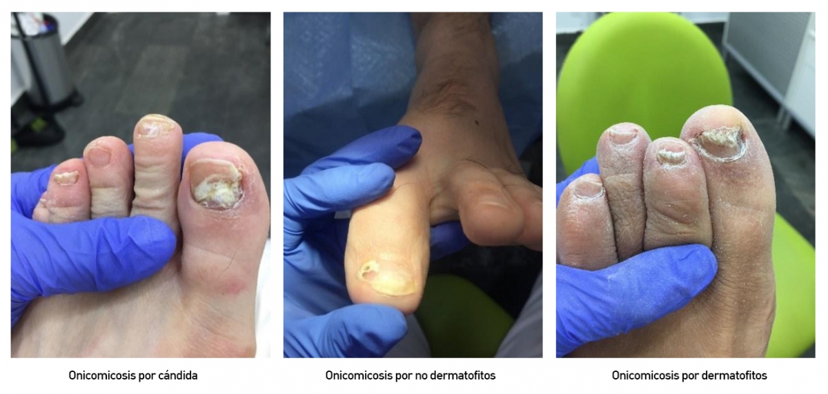 Psoriasis en las uñas, piel y articulaciones de los pies. Consejos para ...