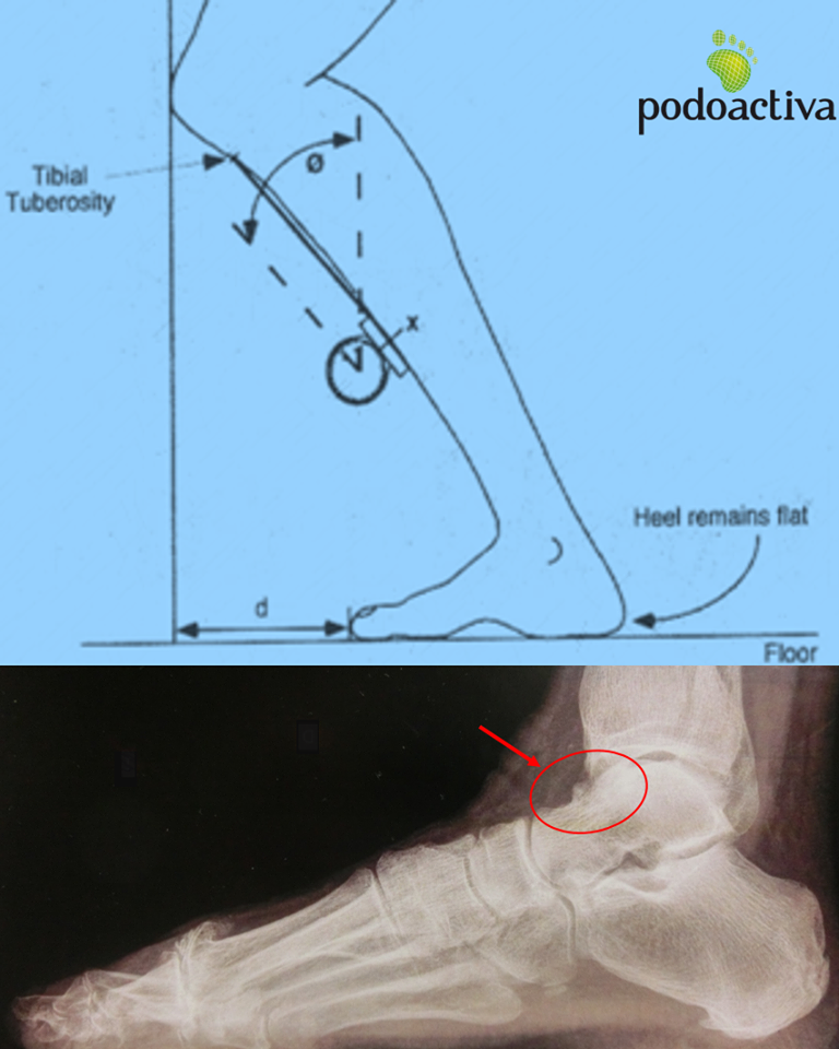 Impingement o choque anterior de tobillo - Podoactiva. Líderes en Podología