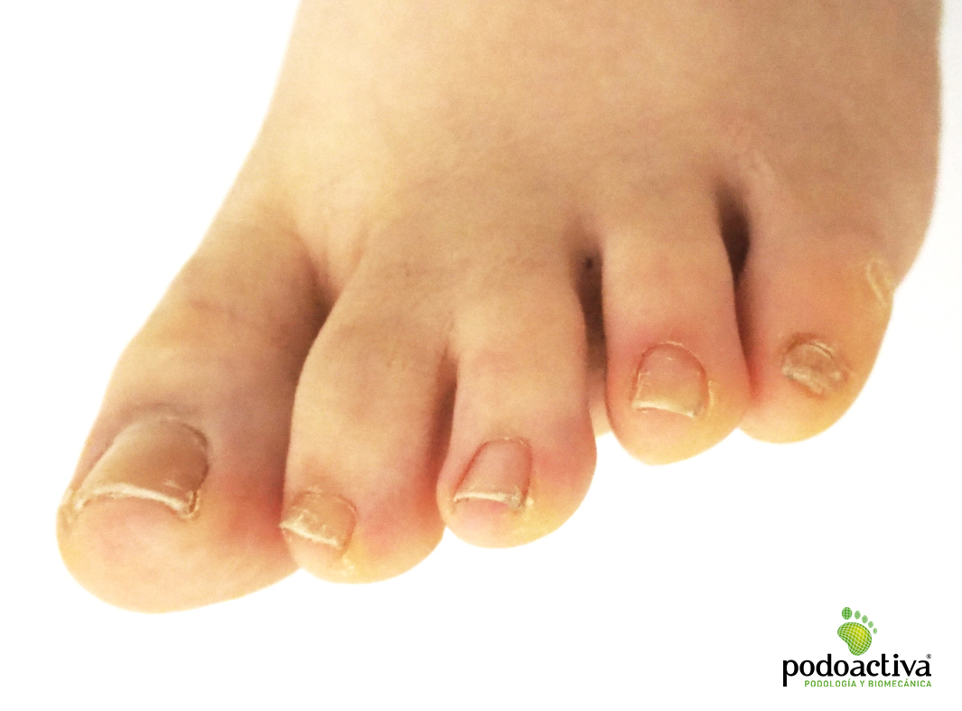 Sindactilia o dedos de los pies o manos pegados. Causas y tratamiento