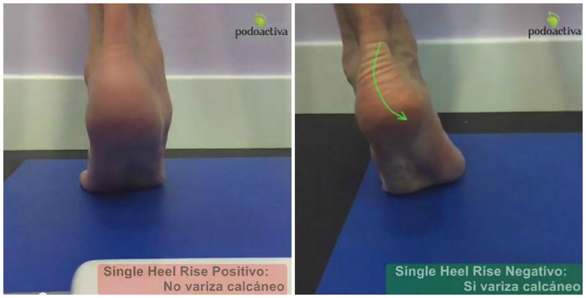 Test de puntillas unilateral "Single Heel Rise Test" - Podoactiva ...